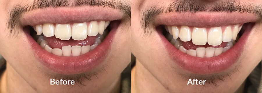 Cosmetic Dentistry in Puyallup and Graham | Advanced Emerald Dentistry