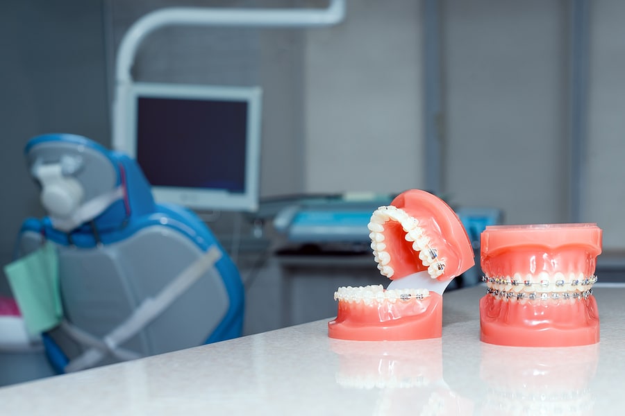 Types of Dental Braces & Choosing the Right One
